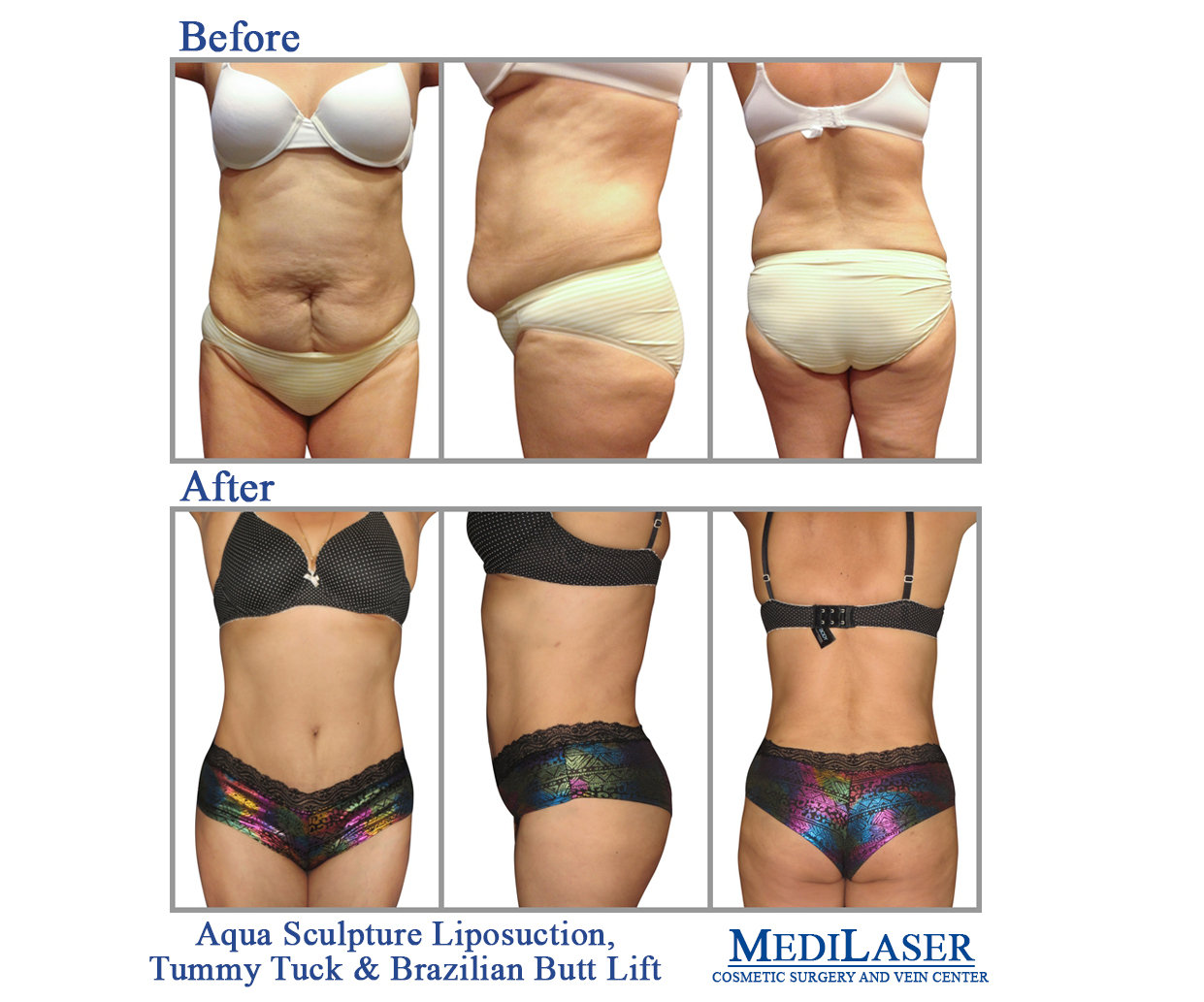 BBL Before & After | Medilaser | Frisco, TX