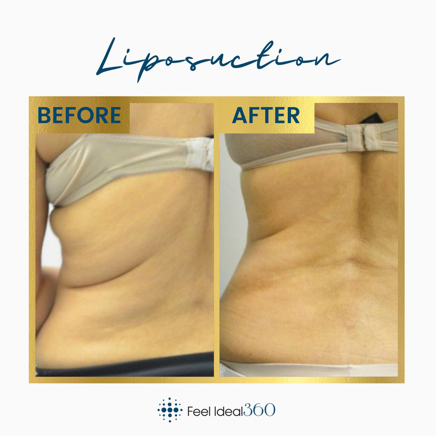 Beautifill Liposuction Before And After Feel Ideal 360 Med Spa