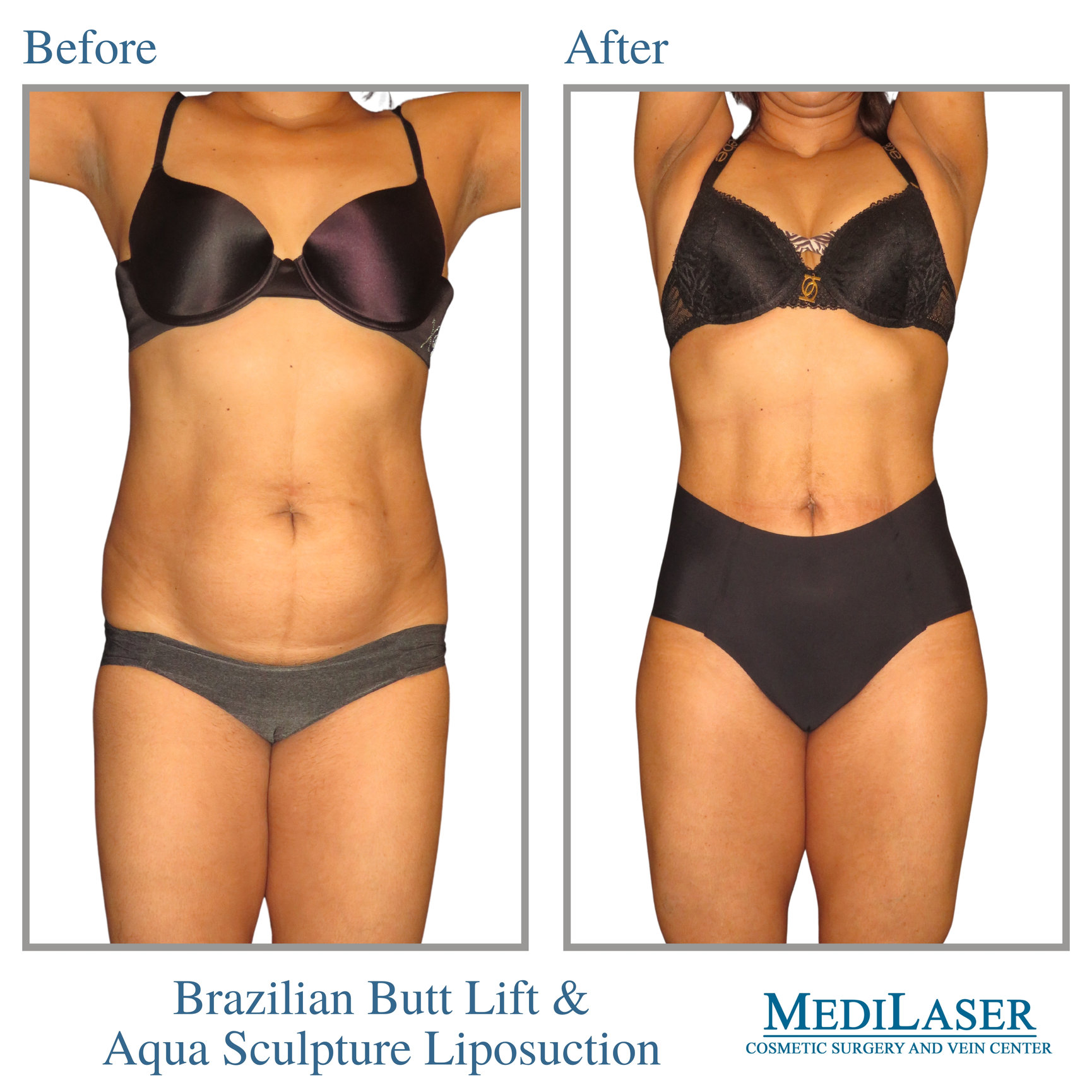 BBL Before & After | Medilaser | Frisco, TX